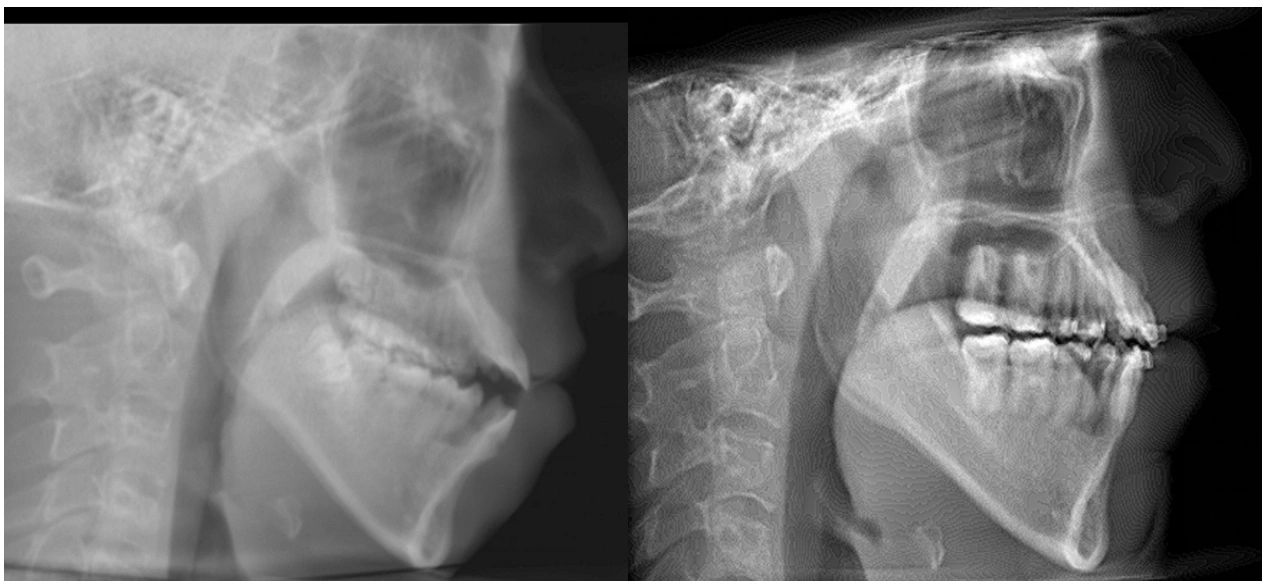 Class Iii And Malocclusion With Open Bite And Mld